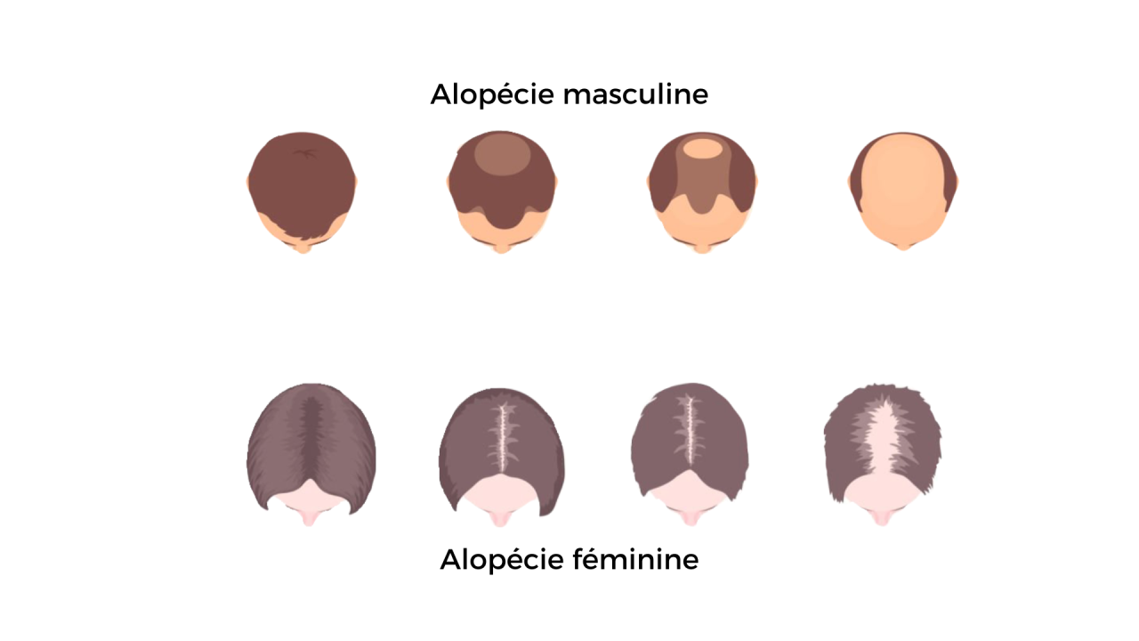 Tout savoir sur l'alopécie - Centre medical et esthétique des Canuts